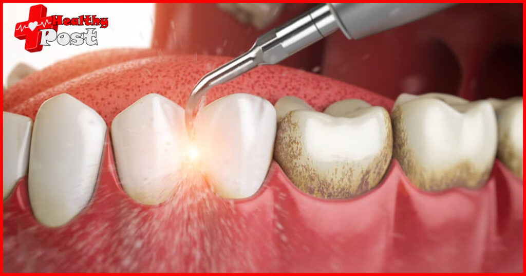 Why don’t some dentists insist on deep cleaning teeth? - Healthy Post