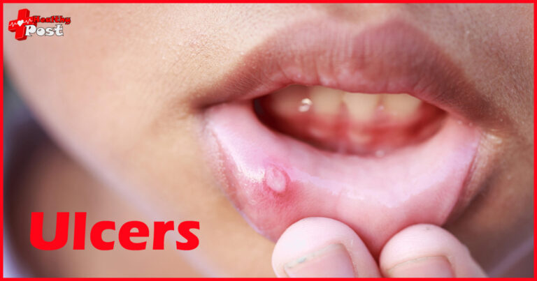 There are 3 types of "ulcers" in the mouth, It's not a good sign