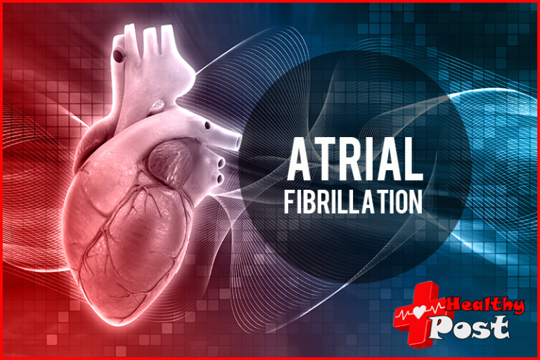 ICD 10 Atrial Fibrillation: A Comprehensive Guide